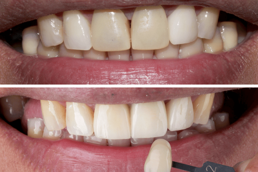 Prosthodontics | Dentist in Dubai | Queens Medical Center